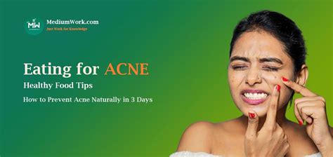 How To Prevent Acne Naturally In 3 Days Medium Work