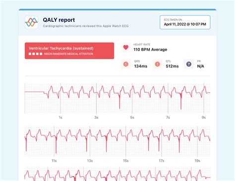 Calculating Qt Interval Expert Tips And Techniques Qaly