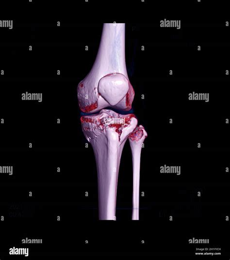 Ct Knee Joint 3d Rendering Image Showing Fracture Tibia Bone Stock