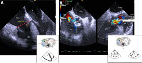 Transesophageal Echocardiography Evaluation Of Tricuspid Annulus And