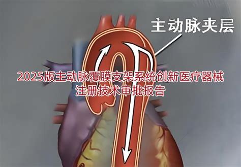 2025版主动脉覆膜支架系统创新医疗器械注册技术审批报告 知乎
