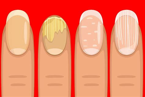Things Your Nails Can Tell You About Your Health Quizzable News