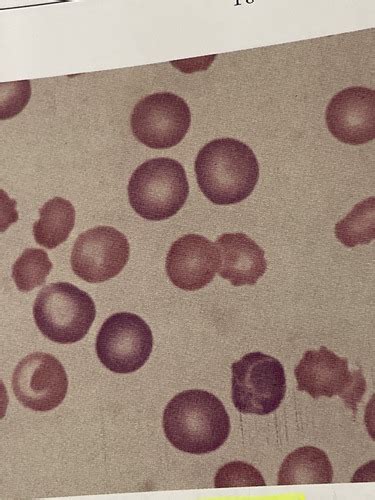 Abnormal Erythrocyte Morphology Pictures Flashcards Quizlet