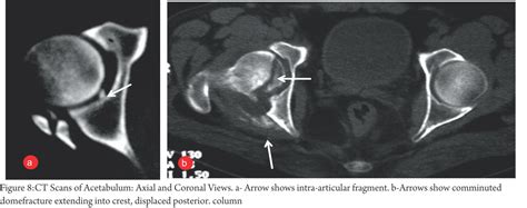 Acetabular Fracture X Ray At Samantha Lackey Blog