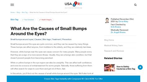 Small Bumps Under Eyes Beauty Tips