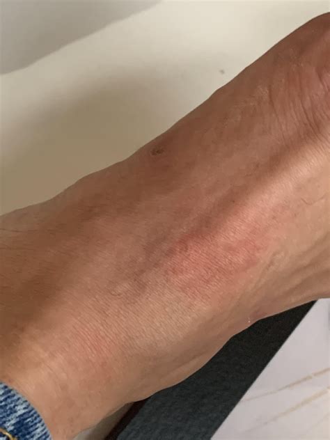 Worms Under My Skin Circular Raised Tubes And They Move Around Can