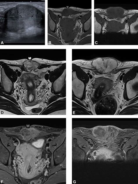 A Preoperative Ultrasound Ultrasound Exam At Diagnosis Showing A