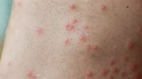 Rise In Skin Disfiguring Parasite Infections Spreading Across Us Spark