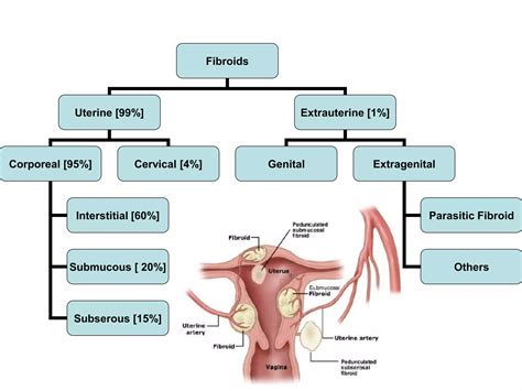 Uterine Fibroids Ppt
