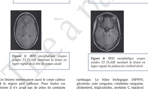 IRM encéphalique coupes axiales T FLAIR montrant les lésions en hyper Download Scientific