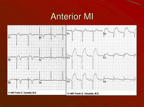 Ppt Ekg Myocardial Infarction And Other Ischemic States Powerpoint