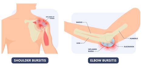 Laser Therapy Revolutionizes Bursitis Treatment