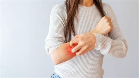 Egzama Atopik Dermatit Nedir Belirtileri Ve Nedenleri 46 OFF