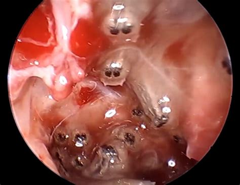 【閲覧注意】5歳の女の子の ”穴” の中にあったものは、私達を震撼させた（画像あり） ポッカキットポッカキット