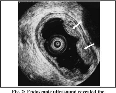 Figure 1 From Multiple Granular Cell Tumor Of The Esophagus Treated