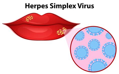 Herpes Simplex