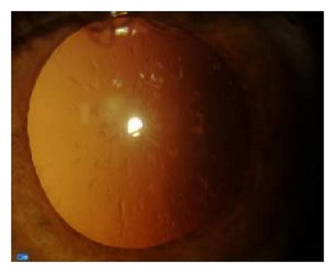 Progression Of Cataract In The Left Eye Of The Patient Described In The