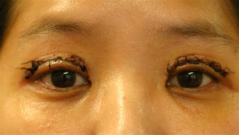 Asian Double Eyelid Surgery Asian Blepharoplasty Mr David Cheung