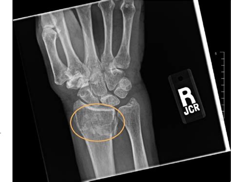 Pdf Distal Radius Fracture With Dorsal Angulation Semantic Scholar