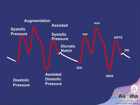 Iabp Principle Hemodynamic Timing Weaning 2016 Background Asmihaisman Edit Pptx