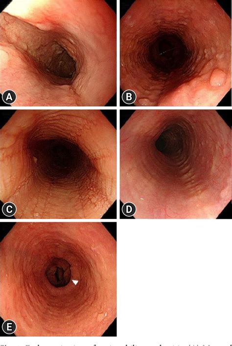 Figure 1 From Role Of Endoscopy In Eosinophilic Esophagitis Semantic