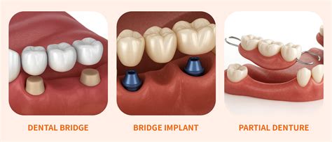 Comparing Partial Dentures Bridges And Implant Supported Bridges