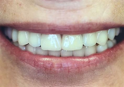 Partial Dentures Nottingham Kevin Manners Denture Clinics