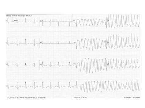 Ecg Wide Qrs Tachycardia Ppt Heart And Cardiovascular Diseases
