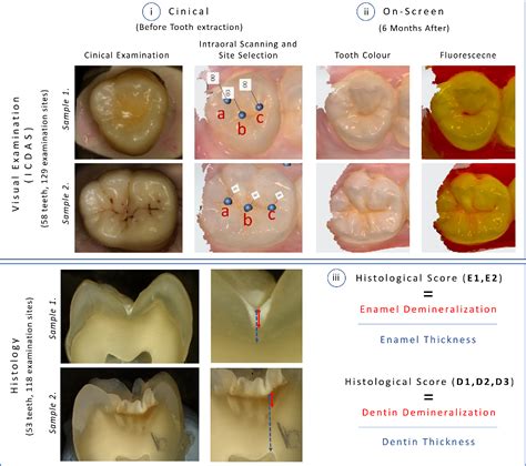 Figure 1 From Occlusal Caries Detection On 3d Models Obtained With An