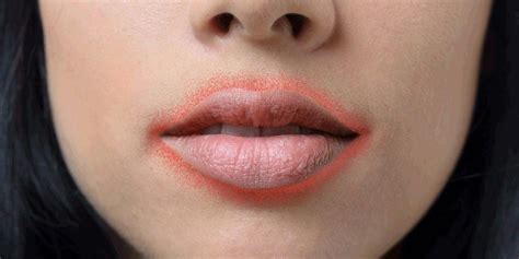 Understanding Perioral Dermatitis What It Is What Triggers It And How To Manage · Glw