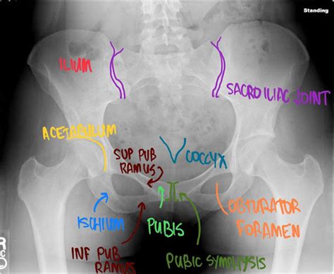 Pelvic Fracture X Ray Learningradiology Pelvic Avulsion Fractures