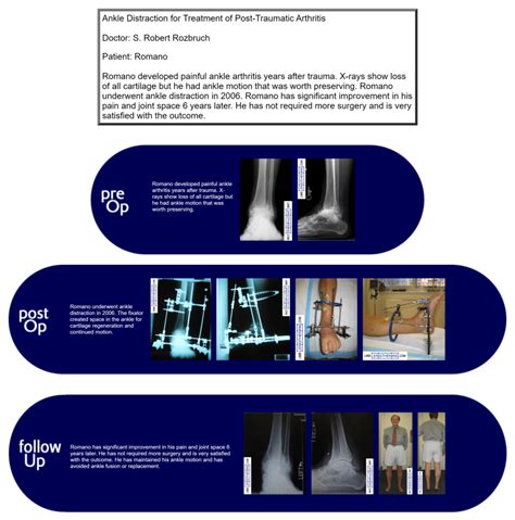 Ankle Reconstruction By Distraction For Treatment Of Post Traumatic
