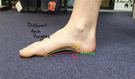 Flat Feet Vs Arched Feet Know The Differences And How To Treat Them