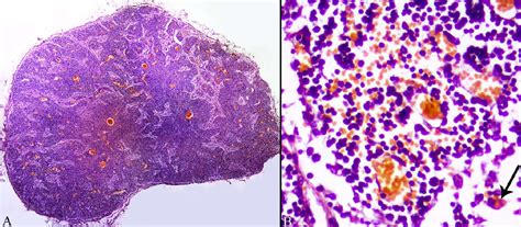 Figure 2 From Subtypes Of Human Atypical Lymph Nodes Defined Based On