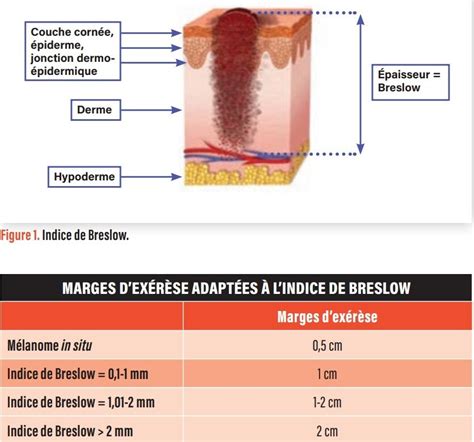 Indice de Breslow dans la prise en charge du mélanome La Revue du