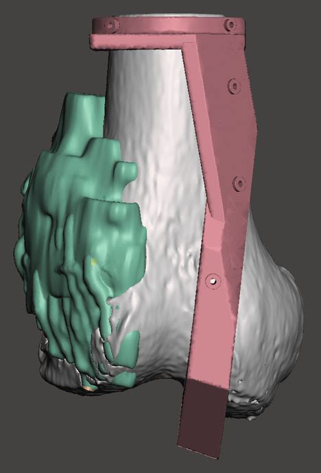 Archivo Stl Femoral Osteosarcoma ♋・diseño Para Descargar Y Imprimir En