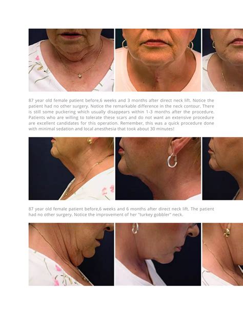 Minimal Incision Facelift Surgery And Lower Face Lift Incisions Pdf