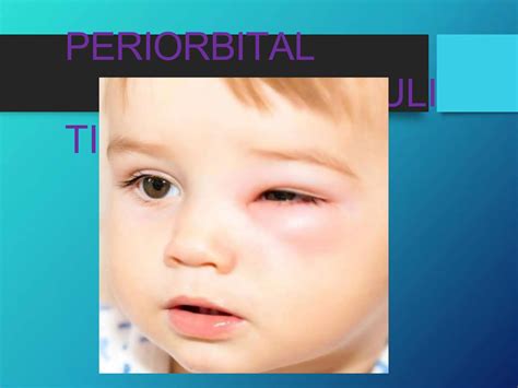 Njunctivitis Eye Ppt