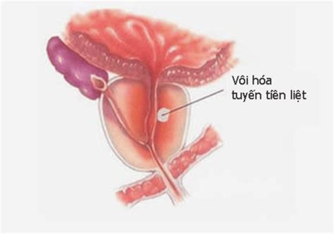 How Is Prostate Calcification Formed And Is It Dangerous Vinmec