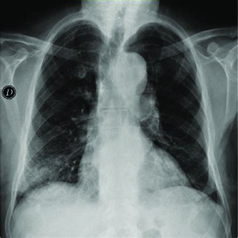 Chest Ct Scan Areas Of Ground Glass Attenuation With Alveolar