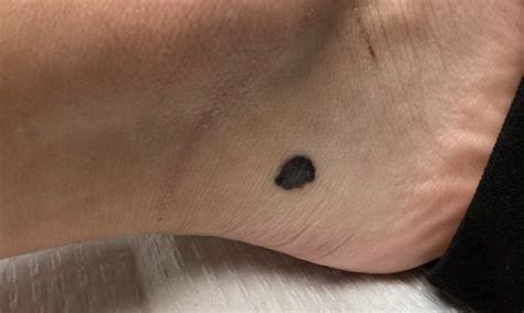 Annual Skin Cancer Screening Early Detection Saves Lives Your Great Skin