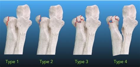 The Armdoc Radial Head And Neck Fractures
