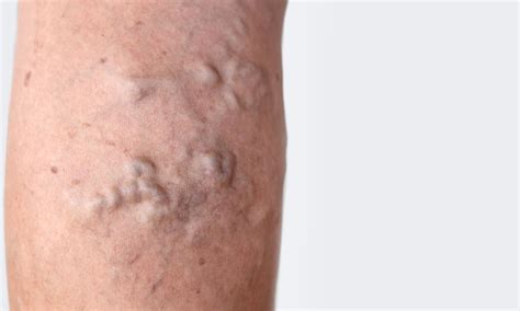 Vene Sporgenti Su Braccia E Mani Quando Preoccuparsi Francesco Collarino