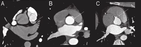 Computed Tomography Multiplanar Reconstruction Mpr Views Of The