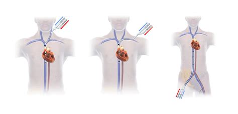 Illustration Double Lumen Cannula In Ecmo Medicalgraphics