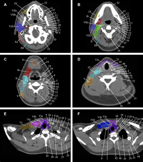 figure 2 from delineation of the neck node levels for head and neck tumors a 2013 update