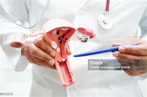 자궁 병원에서 연구 진단 및 치료를 위한 해부학 모델을 들고 있는 의사 Cervicitis에 대한 스톡 사진 및 기타 이미지
