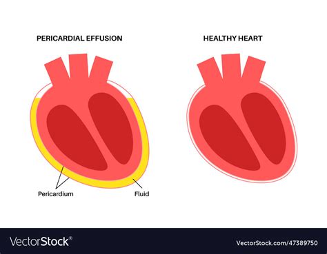 Pericardial Effusion Heart Royalty Free Vector Image