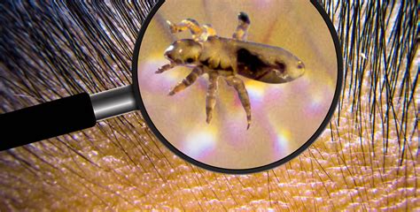 The Life Cycle Of Lice Stages Timeline And More