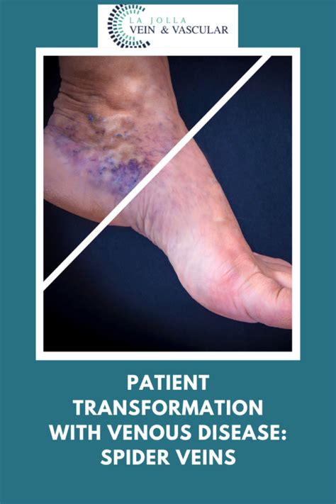 Vein And Vascular Treatment Spider Veins